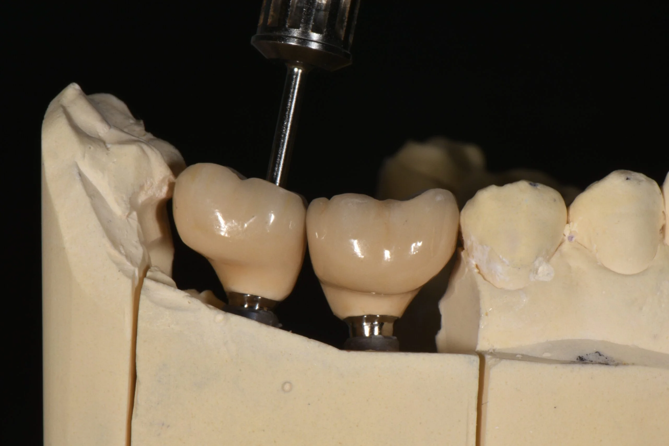 IMPLANT PROSTODONTICS